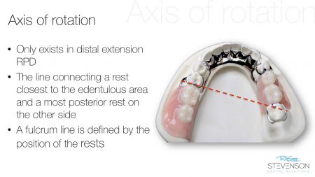 Dental RPD Design Video