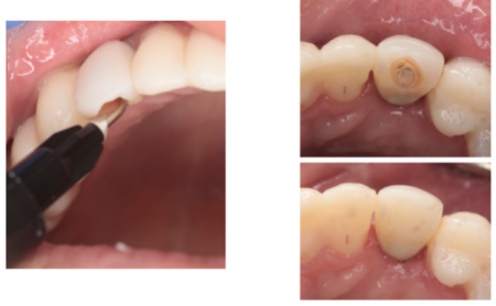 Steps for the Immediate Provisional Implant Crown in the Aesthetic Zone ...