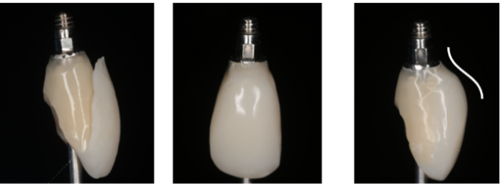 Steps for the Immediate Provisional Implant Crown in the Aesthetic Zone ...