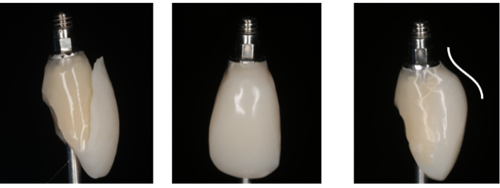 Steps for the Immediate Provisional Implant Crown in the Aesthetic Zone ...