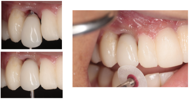 Steps for the Immediate Provisional Implant Crown in the Aesthetic Zone ...