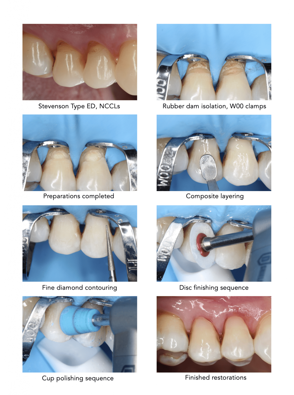 Composite Class V Restorations - Lesion-Specific Approaches