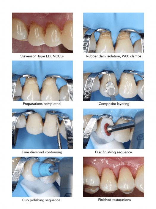 Composite Class V Restorations - Lesion-Specific Approaches