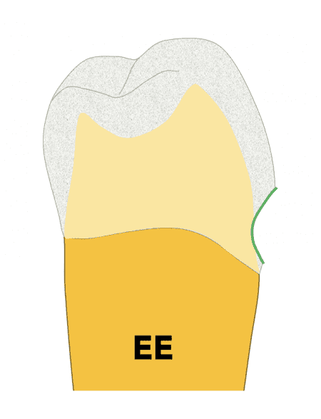 Composite Class V Restorations - Lesion-Specific Approaches