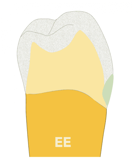 Composite Class V Restorations - Lesion-Specific Approaches