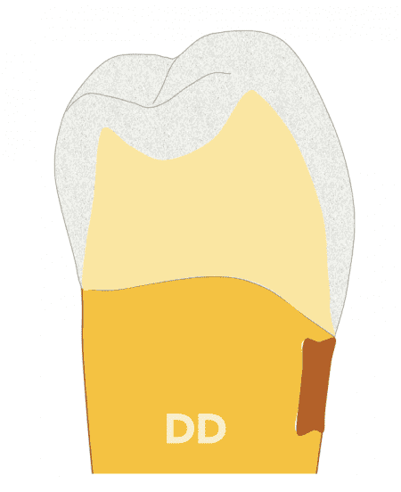 Composite Class V Restorations - Lesion-Specific Approaches