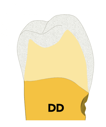 Composite Class V Restorations - Lesion-Specific Approaches