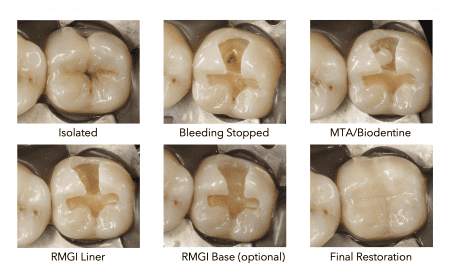 Improve Pulp Capping Success Rate - Dr. Stevenson Shows You How