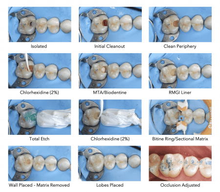 Improve Pulp Capping Success Rate - Dr. Stevenson Shows You How