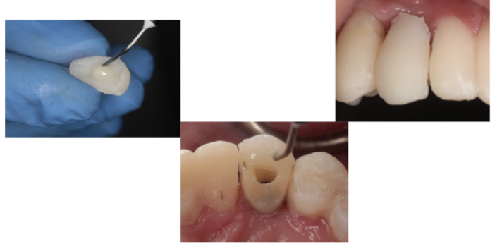 Steps for the Immediate Provisional Implant Crown in the Aesthetic Zone ...