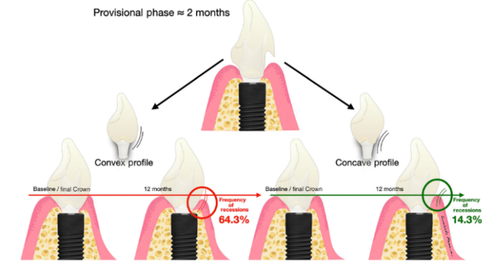 Steps for the Immediate Provisional Implant Crown in the Aesthetic Zone ...