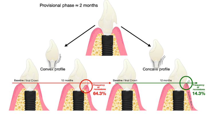 Steps for the Immediate Provisional Implant Crown in the Aesthetic Zone ...