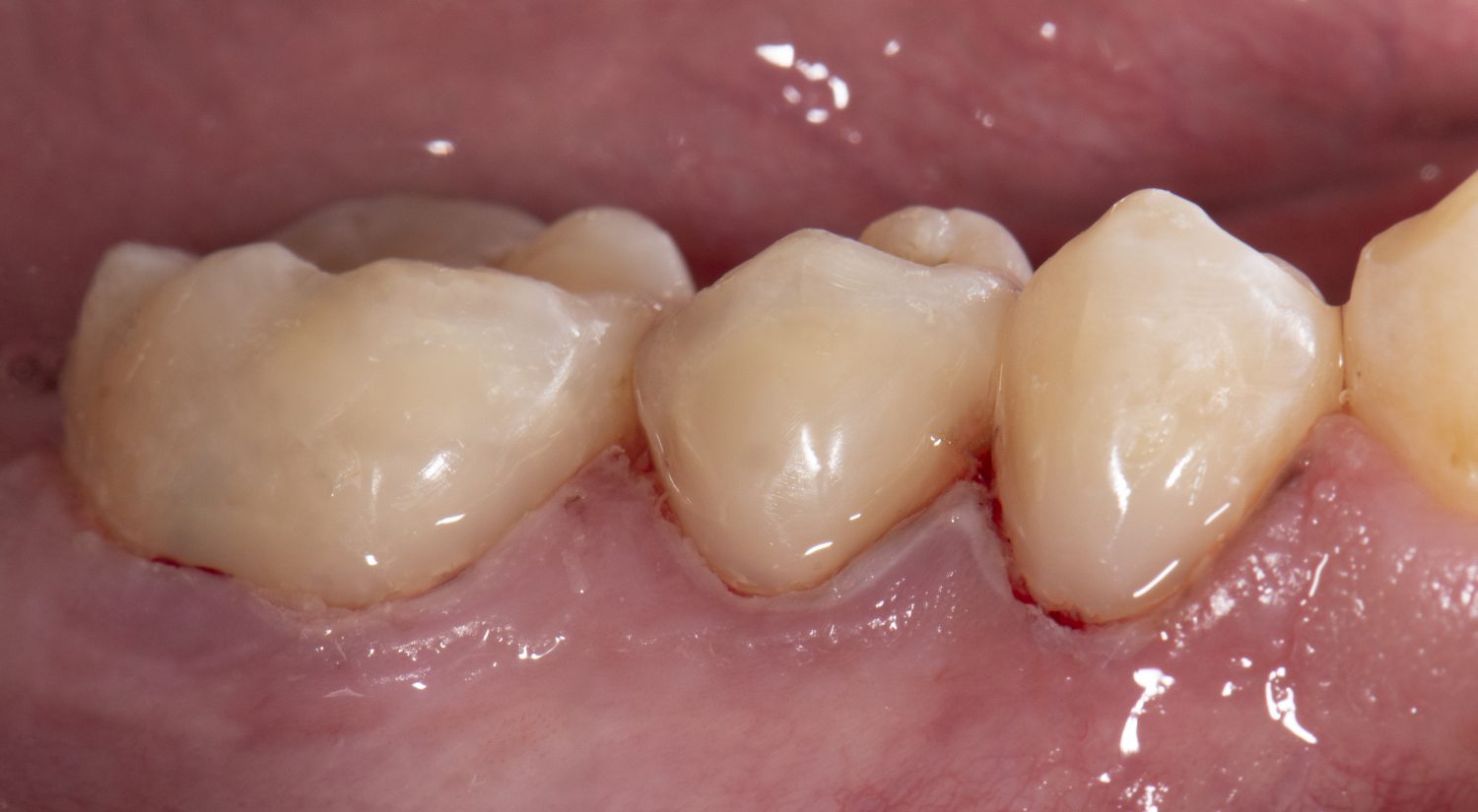 How to benefit from silver diamine fluoride for adult patients