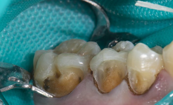 How to benefit from silver diamine fluoride for adult patients