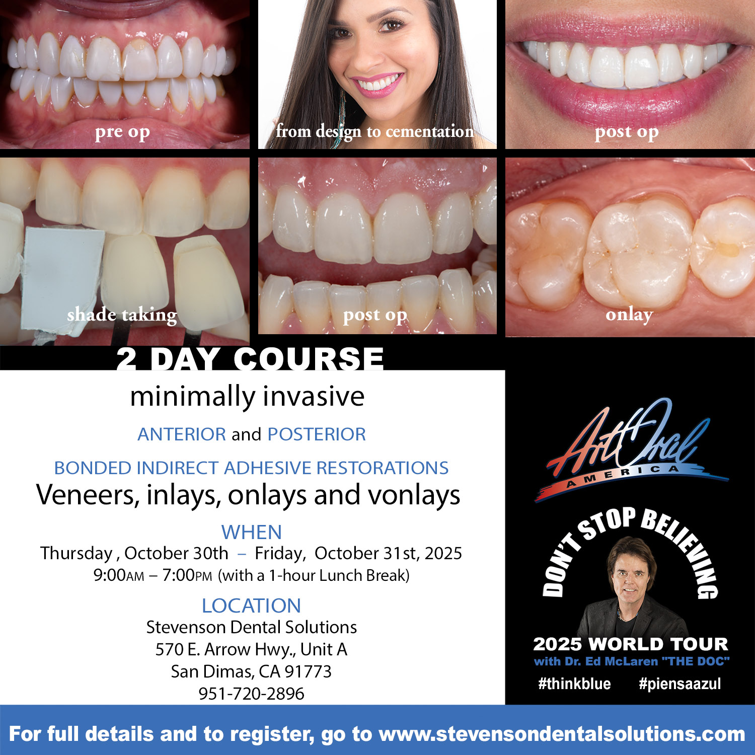 Minimally Invasive Anterior and Posterior Bonded Restorations: Veneers ...